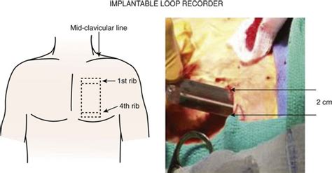 Diagnostic Aspects Of Implantable Devices Thoracic Key
