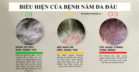 Bệnh Nấm Da đầu Nguyên Nhân Biểu Hiện Và Cách điều Trị