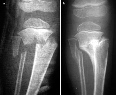 5 This Proximal Tibial Fracture Was Treated Closed After Manipulation Download Scientific