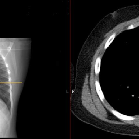 Chest X Ray Cxr Shows A Well Defined Oval Lesion In The Left Download Scientific Diagram