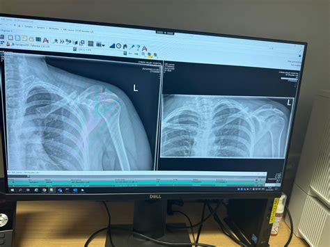 Broken Collarbone Clavic R Brokenbones