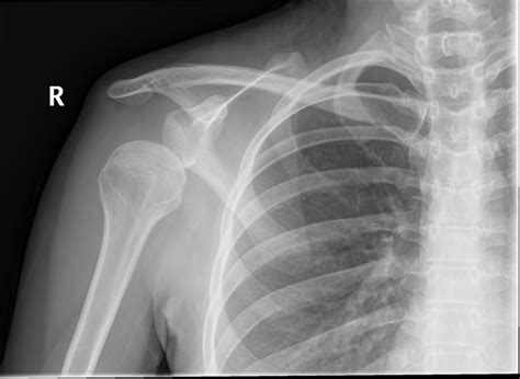Inferior Shoulder Dislocation Pacs