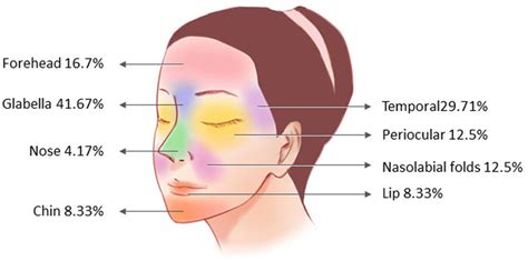 Distribution Of Fat Receiving Areas In Patients With Cerebral