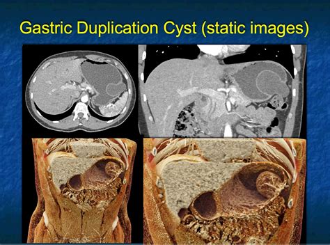 Gastric Duplication Ctisus Cutting Edge Information On Body Ct