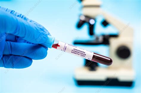 Xeroderma Pigmentosum Genetic Test Stock Image F0451771 Science
