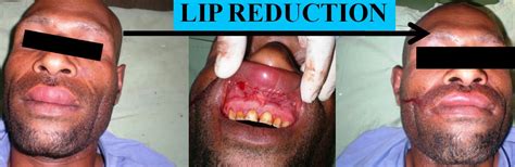 Plastic Reconstructive And Cosmetic Surgery Vital Aesthetic Surgical Enhancement Vase Lip