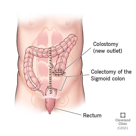 Total Abdominal Colectomy With End Ileostomy Cpt
