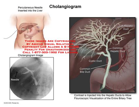 Amicus Illustration Of Amicushepaticductscholangiogrampercutaneous