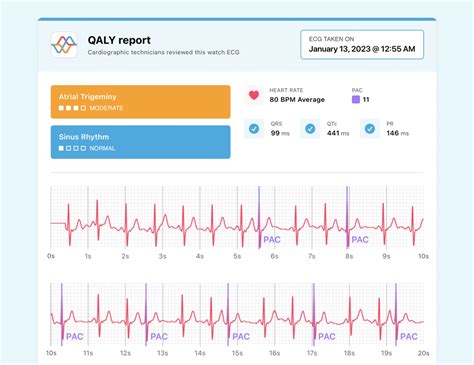 What Atrial Trigeminy Looks Like On Your Watch Ecg Qaly