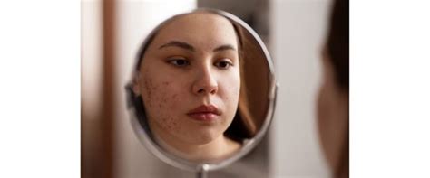 Tak Perlu Beli Acne Patch Ini Trik Atasi Wajah Penuh Jerawat Dan Bekasnya Pakai 1 Bahan Pemanis