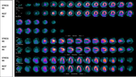 Resolution Recovery And Noise Regularization In Nuclear Cardiology