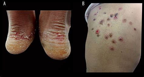 Epidermolytic Ichthyosis