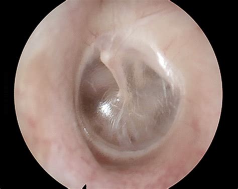 Healthy Eardrum Image Gallery