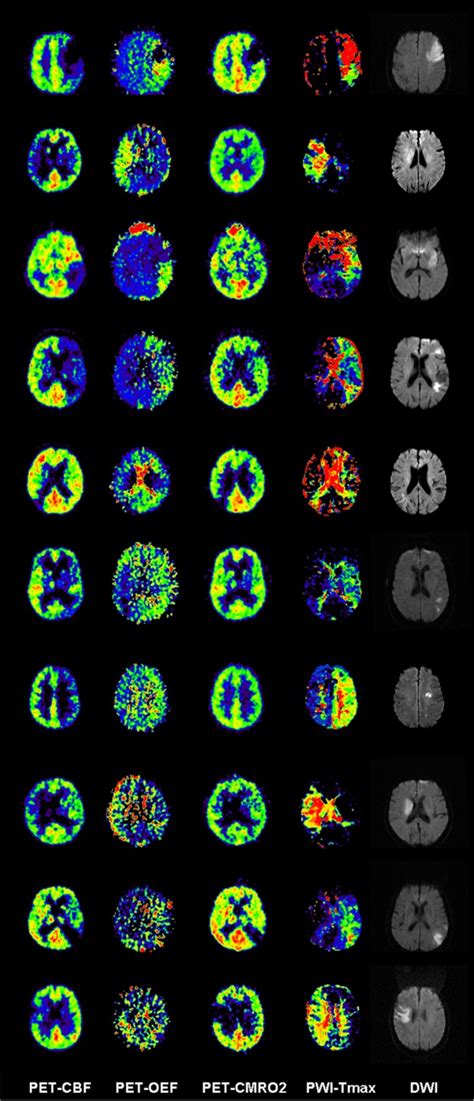 Penumbra Detection In Acute Stroke With Perfusion Magnetic Resonance