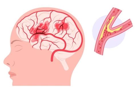 Transient Ischaemic Attack Tia What Is A Mini Stroke Bhf