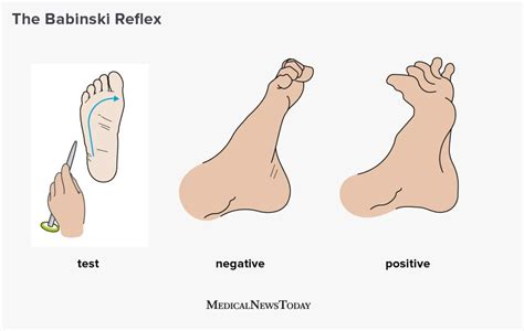 Plantar Reflex Definition At Genevieve Tarrant Blog