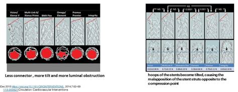 Lm Stent Longitudinal Deformation Saudi Arabian Cardiac