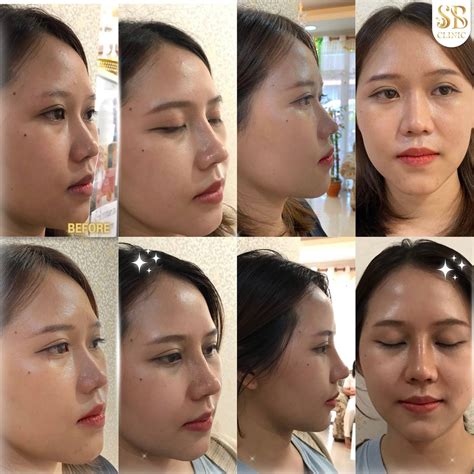 รูป Sb Clinic สมบูรณ์การแพทย์ ขอนแก่น เสริมจมูกขอนแก่น สมบูรณ์การแพทย์