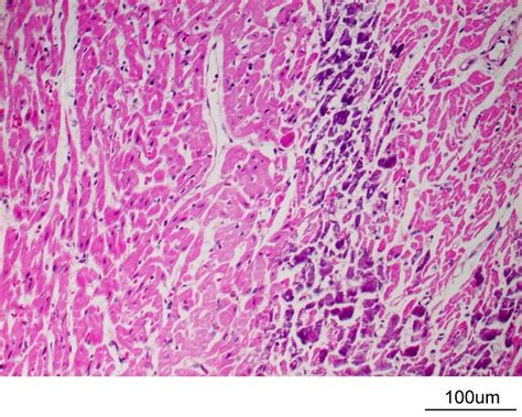 Focal Myocardial Necrosis With Calcifi Stock Image Science Source Images