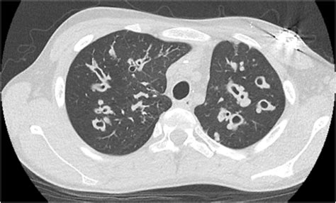 Cf And Bronchiectasis Flashcards Quizlet