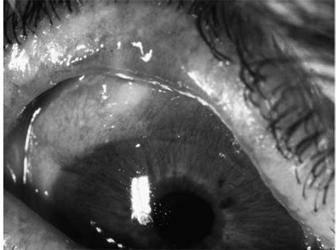 Bacterial Conjunctivitis Ento Key