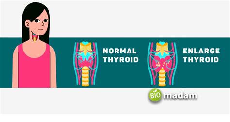 Difference Between Hyperthyroidism And Hypothyroidism Biomadam