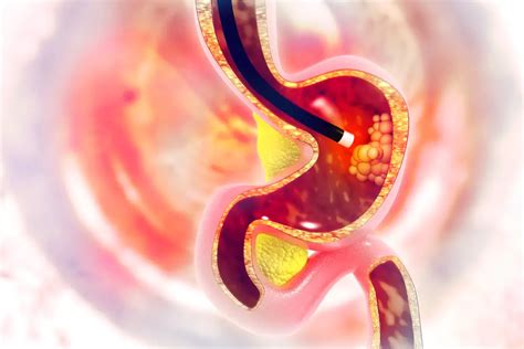 Stomach Polyps Symptoms Causes Diet Treatment Stdgov Blog