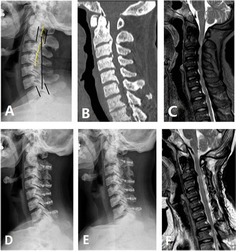 Automated Detection Of Cervical Ossification Of The Posterior