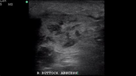 Pocus Soft Tissue Ultrasound Abscess Youtube