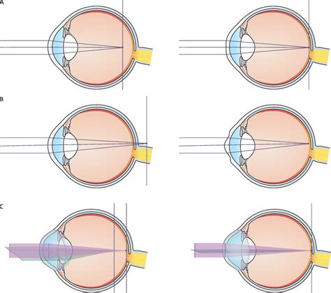 What Is Refractive Error Correction Surgery At Jacqueline Corbett Blog