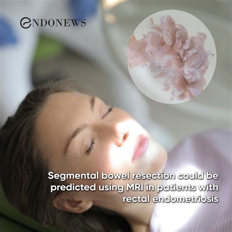 Segmental Bowel Resection Could Be Predicted Using Mri In Patients With Rectal Endometriosis
