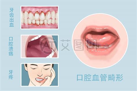 口腔血管畸形图片 医疗图片素材 高清图片素材