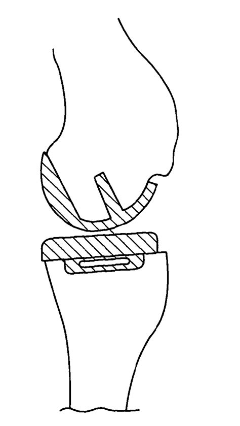 Transtibial Prosthesis Patented Technology Retrieval Search Results Eureka Patsnap