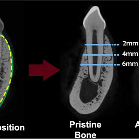Surgical Procedure Bone Defect A Bone Graft B And Bmp 2