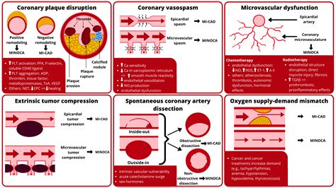 Acute Myocardial Infarction Pathophysiology