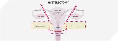 Gynae Laparoscopic Surgeon Vaginal Hysterectomy Specialist