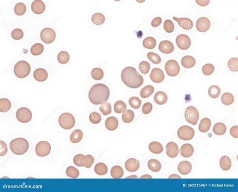 Macrocytosis Stock Image Image Of Medical Disease 362215967