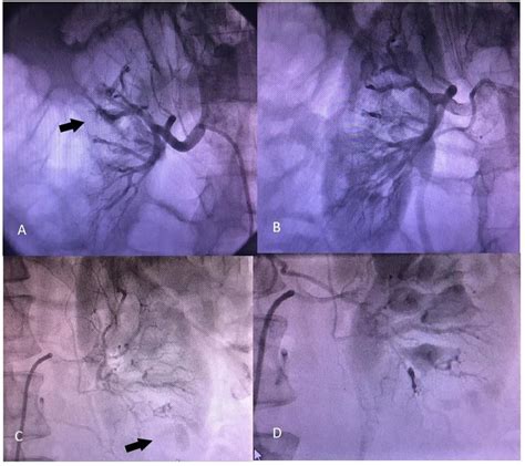 Pseudo Aneurysm And Avf During Dsa A Avf Before Embolization Black