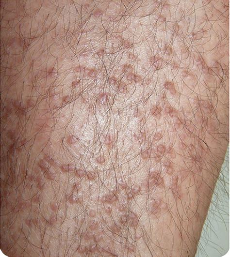 Pruritic Hyperkeratotic Papules On The Legs Of A Patient With Atopic Dermatitis Aafp