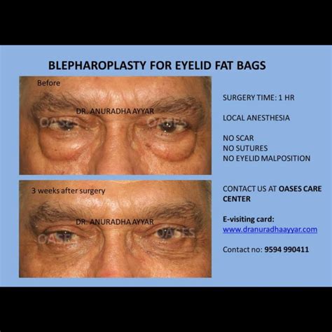 Transconjunctival Scarless Sutureless Eyeplasty Plasticsurgery
