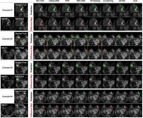 Figure 6 From Multi Modal Tumor Segmentation With Deformable