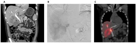 A Patient With A Right Sided Intrahepatic Cholangiocarcinoma Undergoing