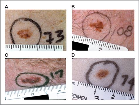 Benign Nevus Vs Melanoma