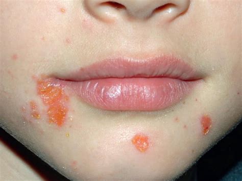 Prescribing In Bacterial Skin Infections Ppt