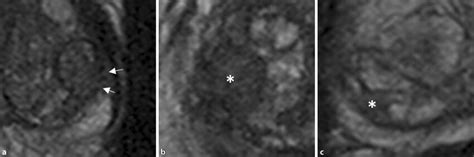 A Typical Nodules Of Benign Prostatic Hyperplasia Bph With A Pi Rads Download Scientific