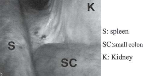Lam I Si And Li Colic Diseases Quizlet