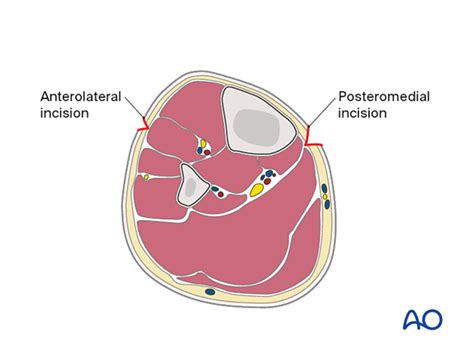 Compartment Syndrome In The Leg