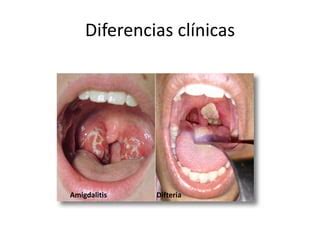 Difteria Conceptos Basicospdf