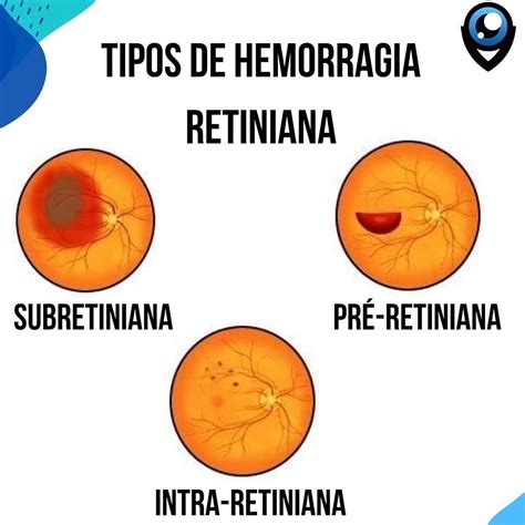 Hemorragia Retiniana Desprendimiento De Retina En Gatos Caso Gris