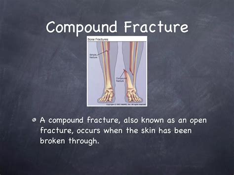 Comminuted Simple And Compound Fractures Ppt